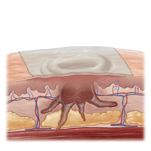 G4Derm™ Plus Synthetic Wound Matrix | Gel4Med